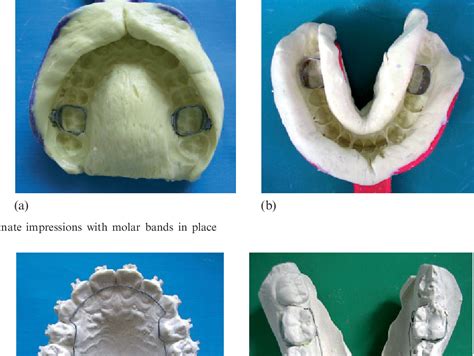 Figure 2 From Molar Bands For ‘precision Bonding Of Lingual Retainers