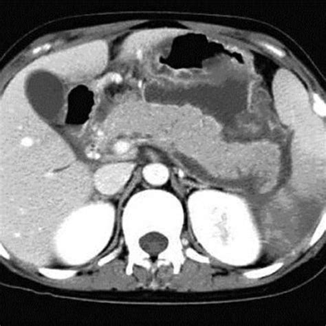 Venous Phase Ct Revealed Thrombosis In The Splenic Vein And Partial