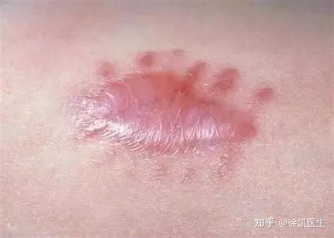 为什么缝针之后的疤痕会凸起呢？这个凸起会不会变平整呢？ 知乎