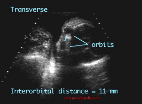 Ethmocephaly Ultrasoundpaedia