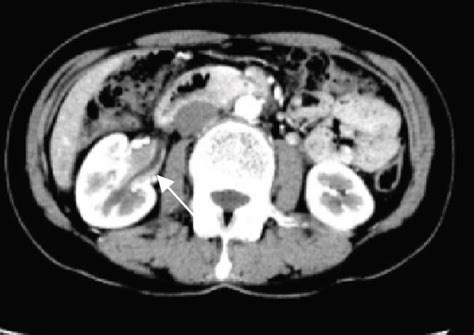 A Ct Scan Revealed Renal Pelvis Mass And Thickening Wall Without