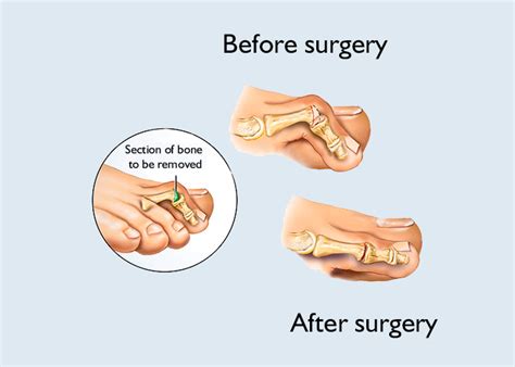 What Is A Hammer Toe Mysurgeryabroad Medicare Hospital Hungary