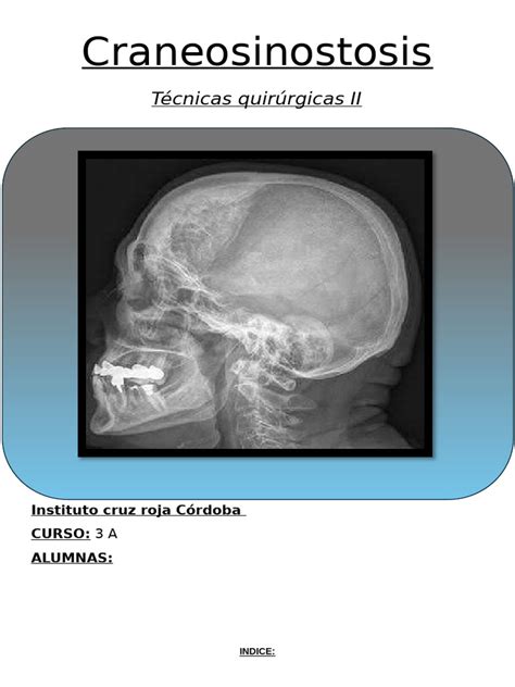 Craneosinostosis Pdf Ct Scan Cirugía