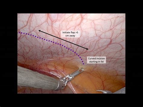 Ventral Hernia 29 Details Of Rtapp Ventral Behind The Knife The