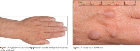 Nodule Vs Papule