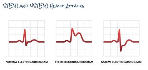 Non St Elevation Myocardial Infarction Heart Attack Scai Seconds Count