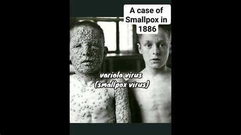Smallpox History