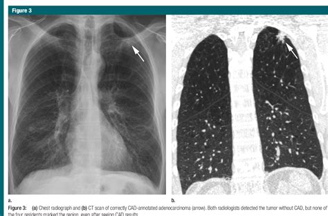 Figure From Computer Aided Detection Of Lung Cancer On Chest