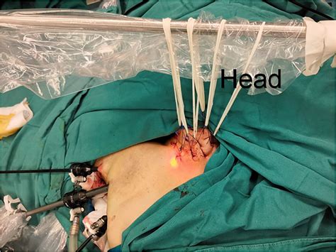 Endoscopic Total Thyroidectomy Using A Unilateral Transaxillary
