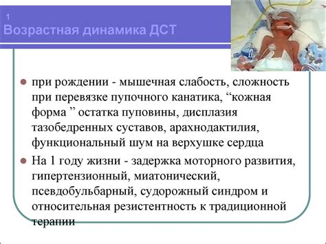 Синдром недиферинцийованной дисплазии соединительной ткани у детей