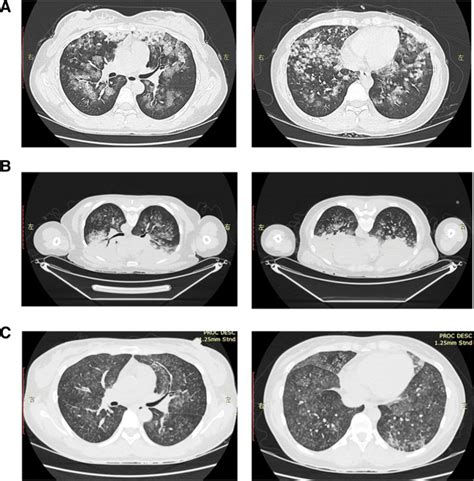 Successful Treatment Of 1 Patient With Chlorine Induced Ards Using