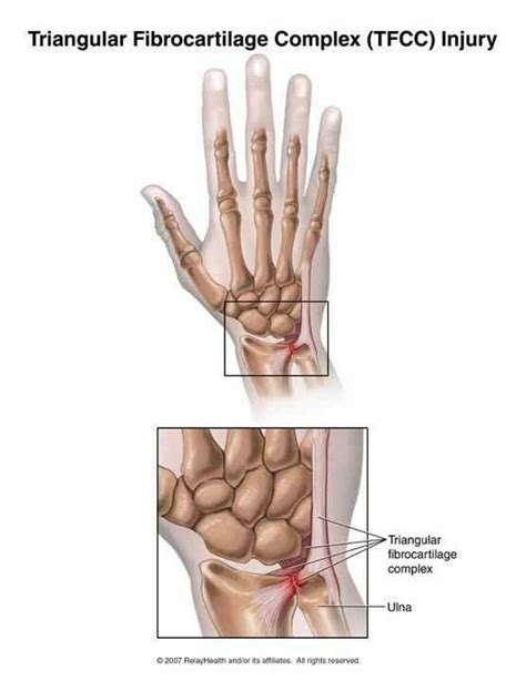 Tfcc Injury