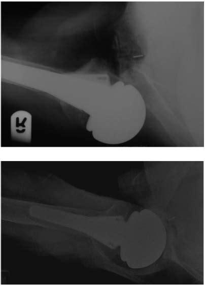 Plain Radiographs A Pre And B Post Revision Surgery For Case 1 Download Scientific Diagram