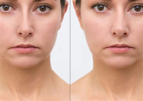 Crooked Nose Rhinoplasty In California Dr Shahrouz Zarrabi Md