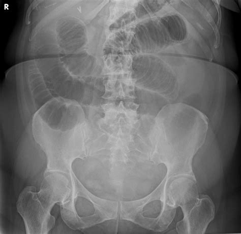 Small Bowel Obstruction Pacs