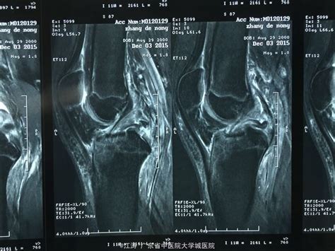 后交叉韧带损伤关节镜下y型人工韧带股骨双束重建 医联