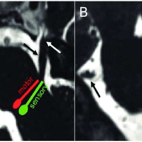 PDF Imaging Evaluation Of Trigeminal Neuralgia