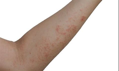 Bed Bug Bites Vs Other Bites Fleas Hives Chiggers 9 Examples