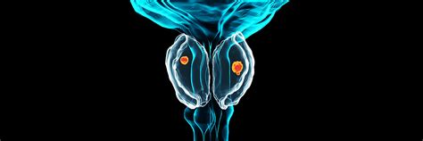 Polygenic Scores Show Promise For Improved Prostate Cancer Detection
