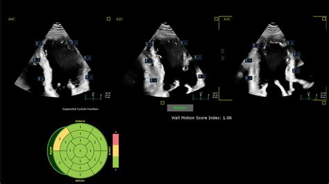Philips Expands And Integrates Echo Ai Platform Cardiac Wire