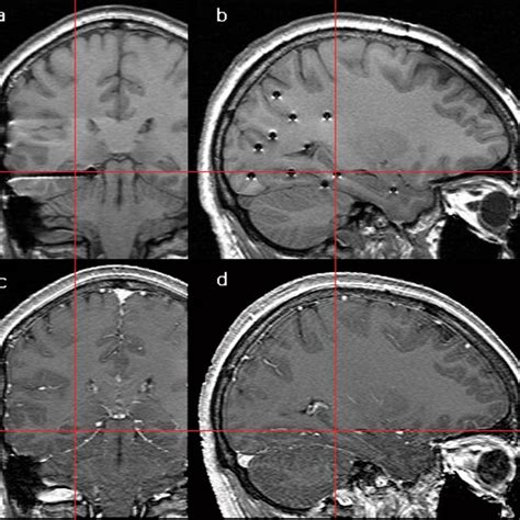 Examples Of EEG Patterns Recorded From Intracranial Cortex And Download Scientific Diagram