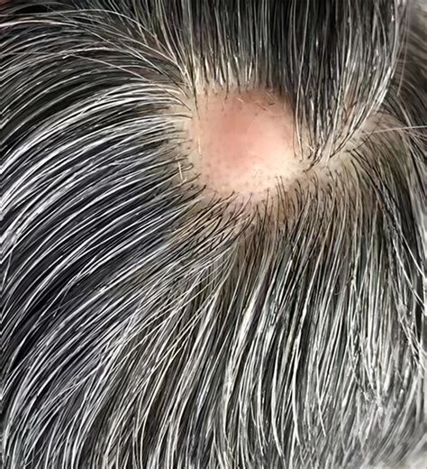 Scalp Metastasis After Breast Cancer Surgery A Case Report Ott