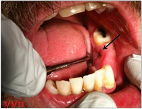 Bisphosphonate Related Osteonecrosis Of The Jaw Treatment Wlysn