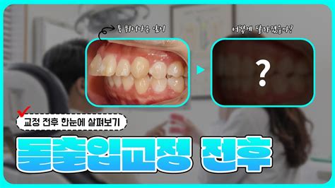 ★돌출입 교정 전후★ 교정 과정 한눈에 살펴보기 입툭튀는 이제 안녕~ Youtube