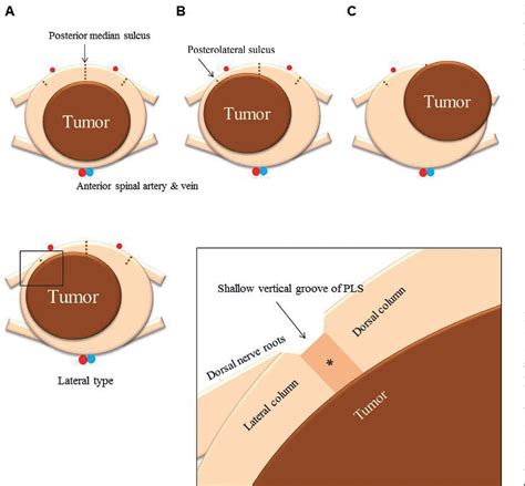 Dorsal Lateral Sulcus