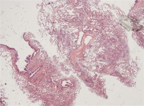 A Overview With Patchy Peribronchial Broadening Of Alveolar Septa And