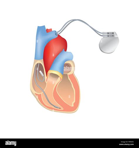 Implantable Icd Hi Res Stock Photography And Images Alamy