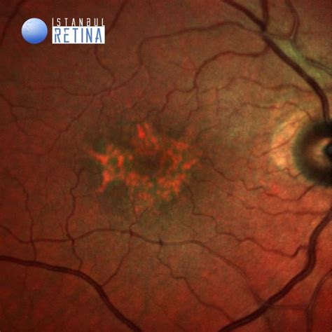 64 Acquired Vitelliform Lesion In The Setting Of Age Related Macular Degeneration Oct Club