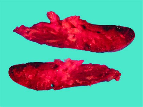 The Cut Surface Of The Extralobar Sequestration From The Right Thoracic Download Scientific