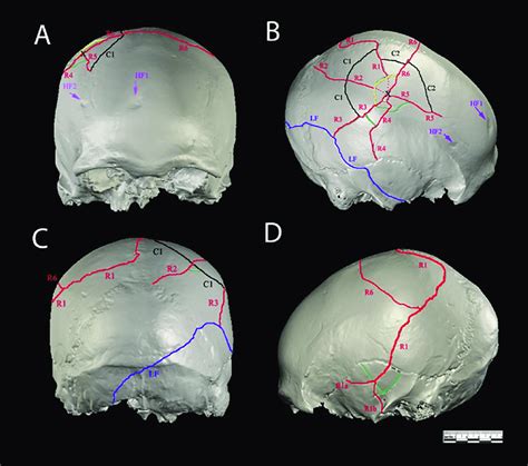 Perimortem Fractures Lf In Blue And Df In Red Yellow And Black Are