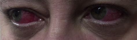 Psoriatic Conjunctivitis At Baseline Download Scientific Diagram