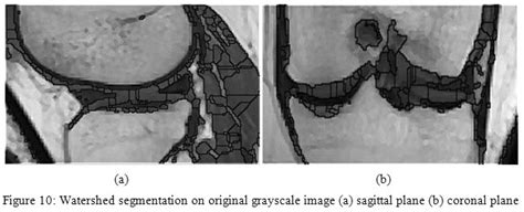 Watershed Algorithm And Adaptive Threshold Canny Edge Detection Based