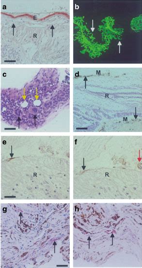 Section Through Proliferative Diabetic Retinopathy Epiretinal Membrane