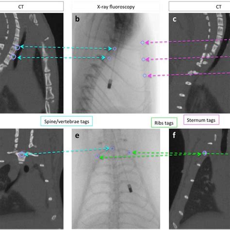 X Ray Fluoroscopy To Ct Registration With Point Matching Method Download Scientific Diagram