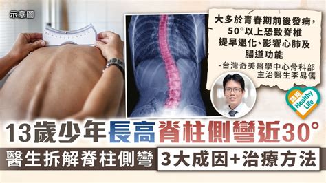 青春期發育︳13歲少年長高脊柱側彎近30° 醫生拆解脊柱側彎3大成因＋治療方法