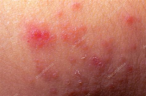 Eczema Atopic Dermatitis Symptom Skin Texture Stock Photo Panxunbin
