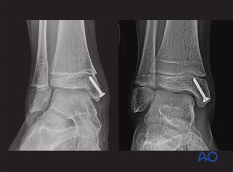 Open Reduction Plate Fixation For Epi Metaphyseal Fractures Salter