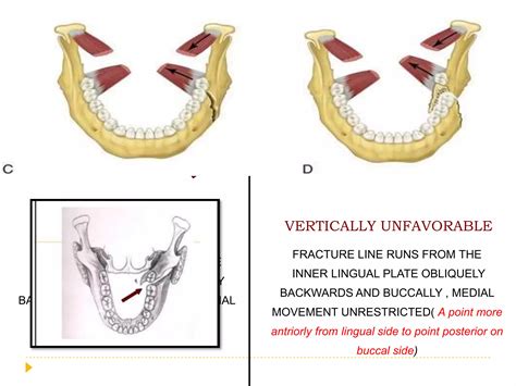 Mandibular Fracture PPTX