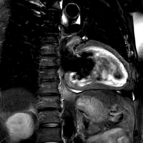 Myocardial Infarction With T1t2 Mapping Philips Mr Body Map