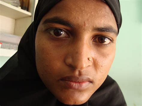 Chronic Hyper Hydrosis Sweat Problem From Last 2 3 Years And Wart