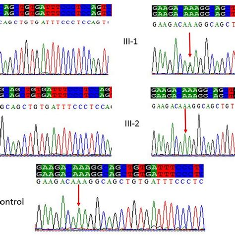 Sanger Sequencing Chromatograms Showing A Missense Mutation Where