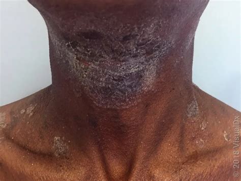 Heres What Psoriasis Looks Like Around The Body With Pictures Goodrx