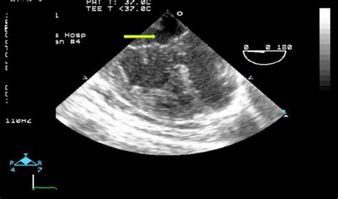 Complete Av Canal Defect With Septum Primum Asd Arrowvsd And