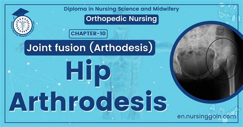 Hip Arthrodesis Chapter 10 Orthopedic Nursing Nursing And Midwifery Gurukul Goln