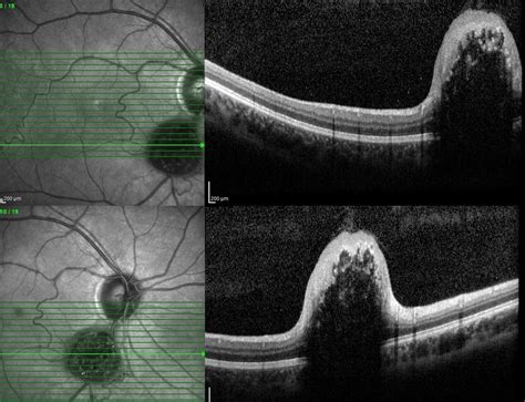 Retinal Astrocytoma In Tuberous Sclerosis Retinara