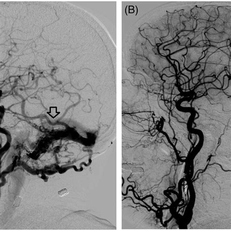 Type 3 Dural Arteriovenous Fistula Davf Lateral View Of A Common